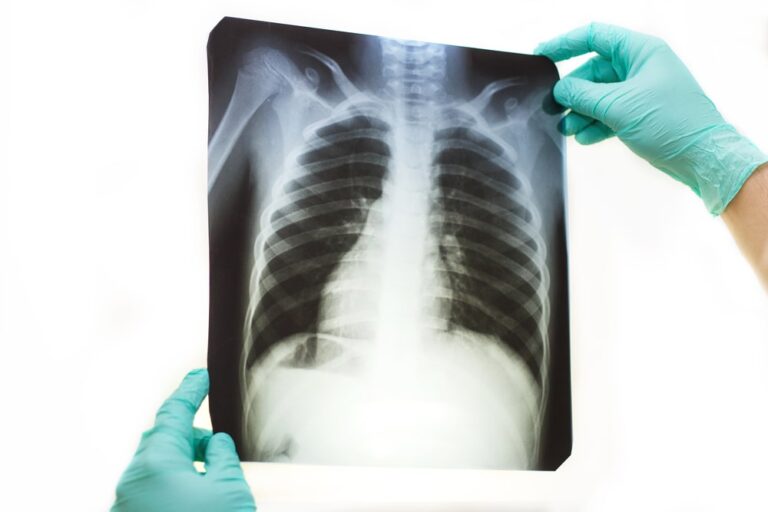 Inside Chest X-Rays: What to Expect and What They Reveal